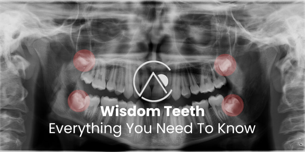 Wisdom Teeth: Everything You Need To Know – Cronin & Czarnik Orthodontics